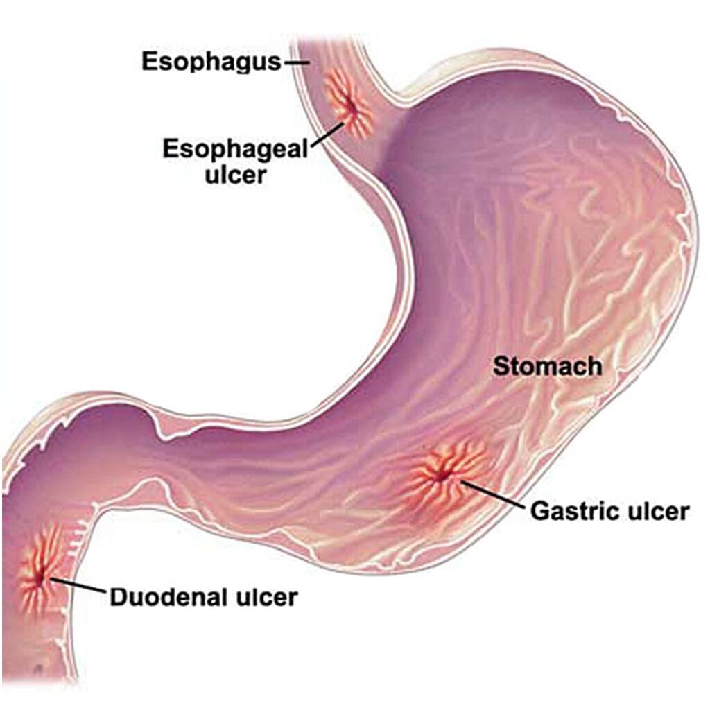 Best esophagus surgery in Ahmedabad | Dr. Gastro