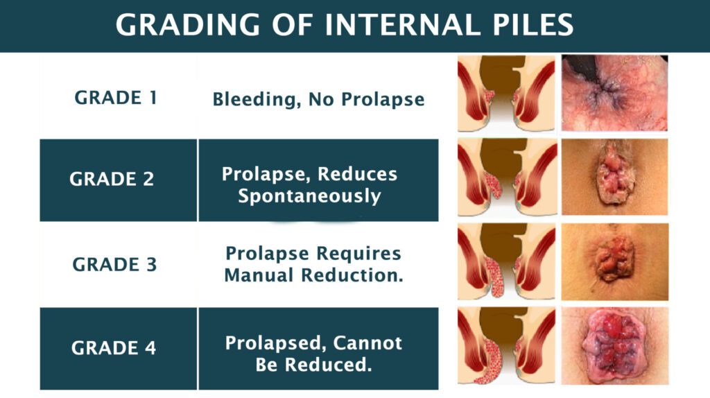 Best Piles Treatment in ahmedabad | Dr. Gastro